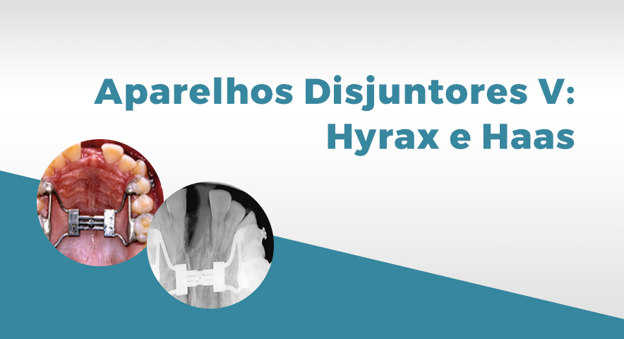 Aparelhos Ortodônticos: Hyrax e Haas