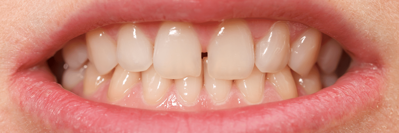 Caso clínico: diastema interincisivos - Blog Dental Cremer | Henry Schein