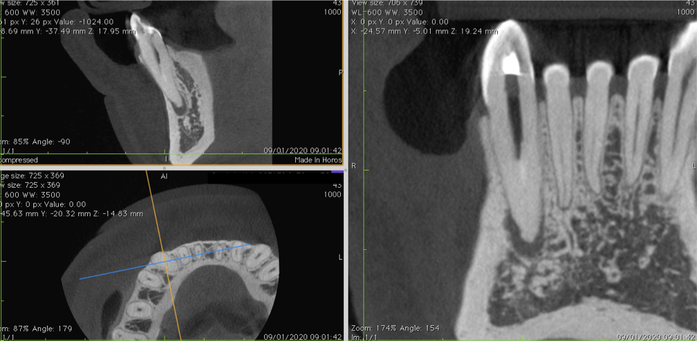 Como tratar paciente com canal calcificado de forma eficaz