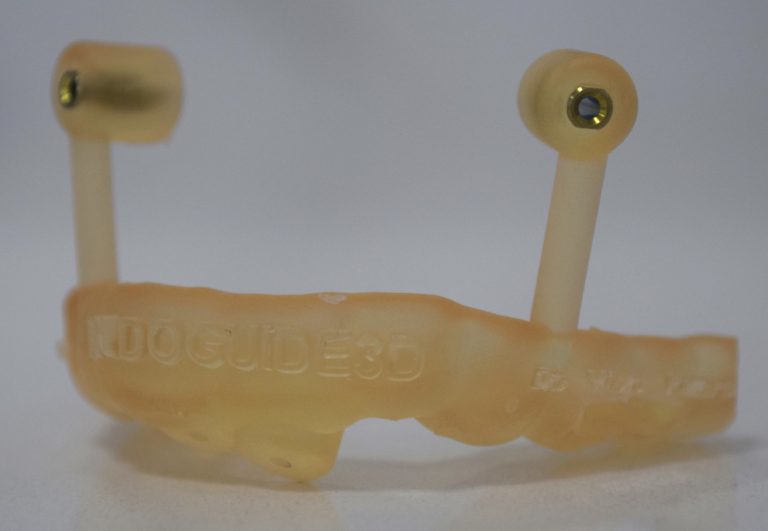 Como tratar paciente com canal calcificado de forma eficaz