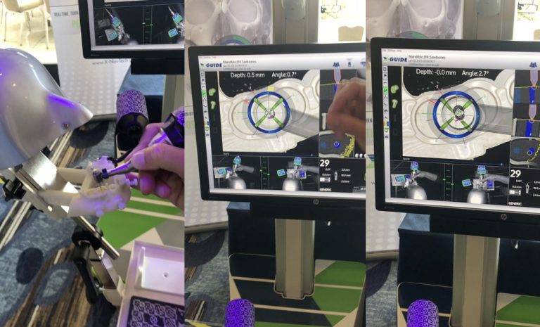 Como tratar paciente com canal calcificado de forma eficaz