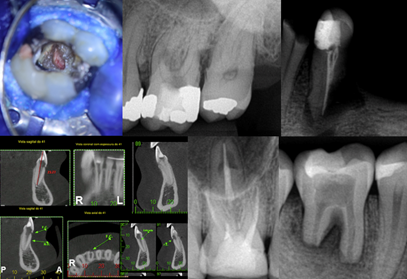 O uso dos biocerâmicos na Endodontia - Blog Dental Cremer