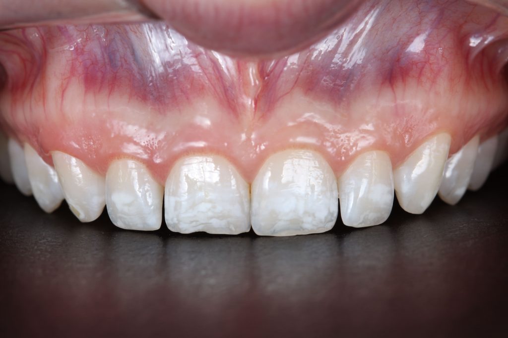 Fluorose dental: microabrasão do esmalte associado ao clareamento