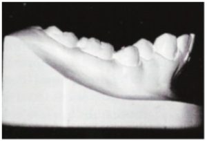 Sobremordida exagerada é mais comum que você pensa!